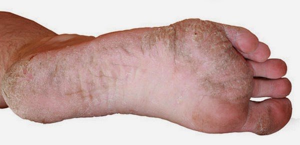 How to get rid of - Dry, Cracked Skin on Feet : Health Blog